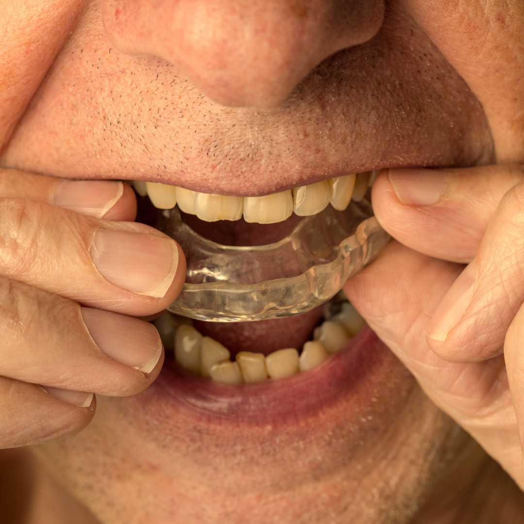 Sports Guard Airdrie | You First Dental